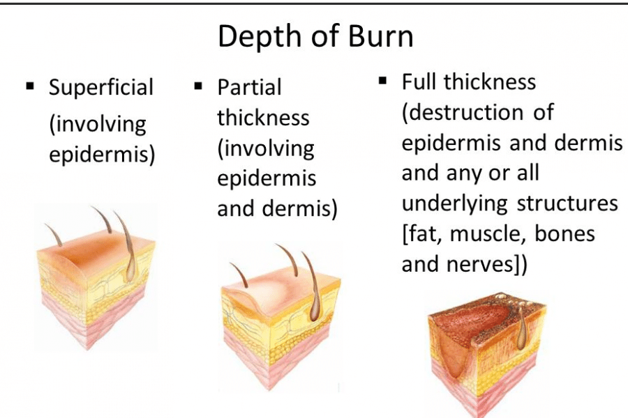 Assessment and Referral of Burn Patients - Department of Surgery Assessment and Referral of Burn Patients - Department of Surgery