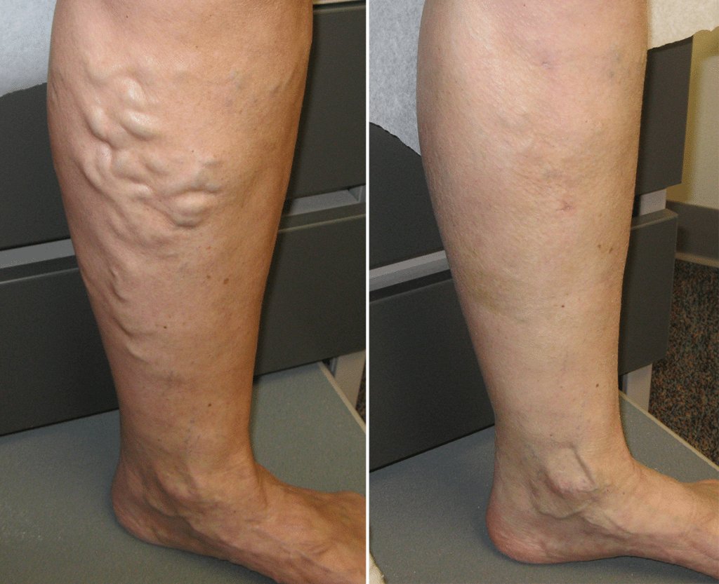 Updates In Varicose Vein Treatment Department Of Surgery Updates In Varicose Vein Treatment Department Of Surgery
